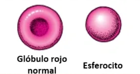 Esferocitosis Hereditaria | Genially