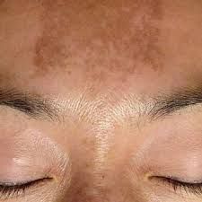 C05 - Anomalies de la pigmentation | Genially