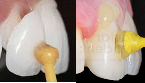 Indicaciones Generales Cementos Resinosos