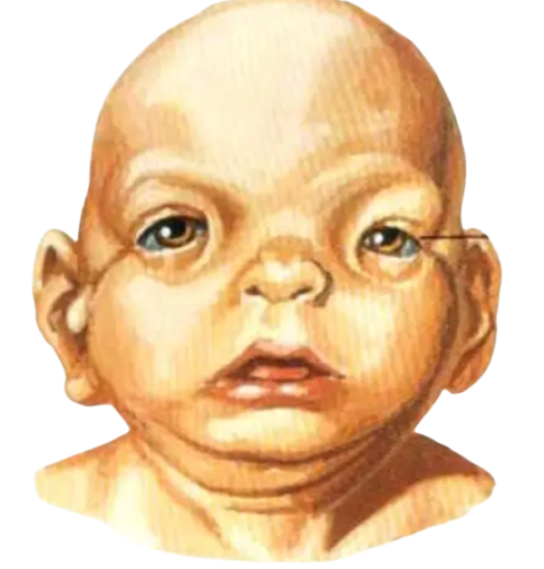 Sindrome de cri du chat | Genially