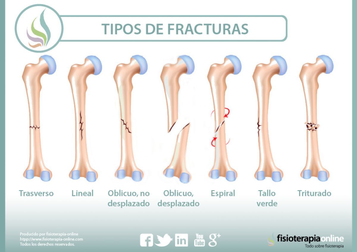 infografia de las fracturas | Genially