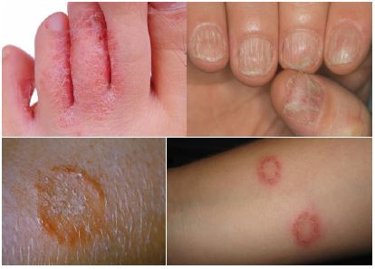 Enfermedades producidas por hongos