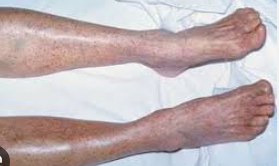 ANEMIA APLÁSICA SEVERA | Genially