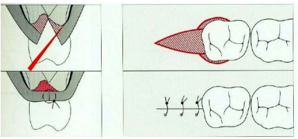 Procedimientos Quirurgicos Periodontales