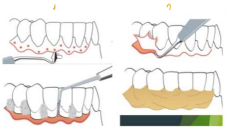 Procedimientos Quirurgicos Periodontales
