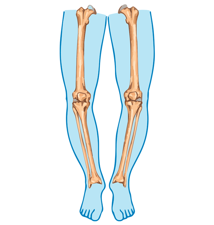 GENU VALGO Y VARO | Genially