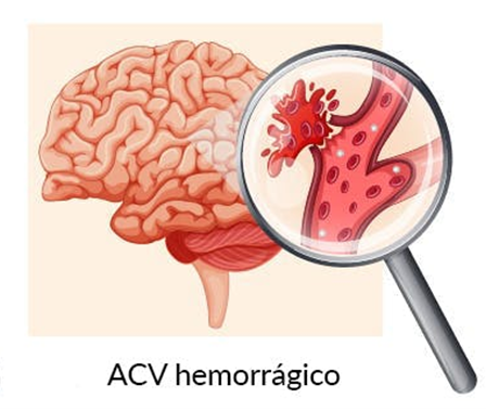 ACV isquemico y hemorragico | Genially