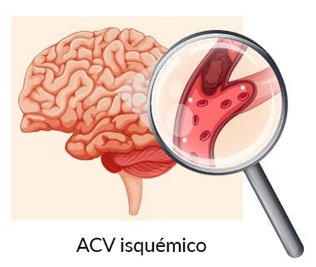 ACV isquemico y hemorragico | Genially