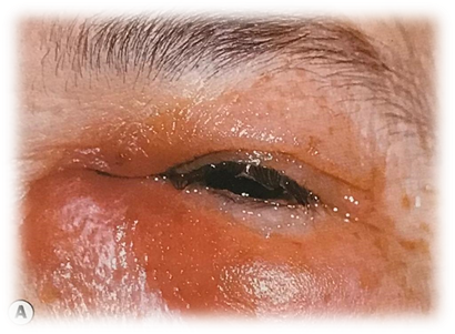 Dacrioadenitis y dacriocistitis | Genially