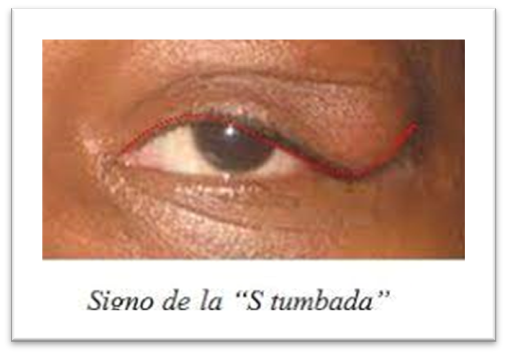 Dacrioadenitis y dacriocistitis | Genially