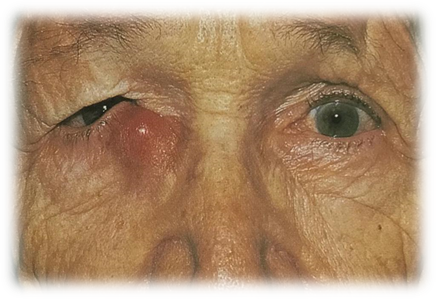 Dacrioadenitis y dacriocistitis | Genially