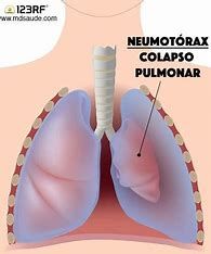Colapso Pulmonar