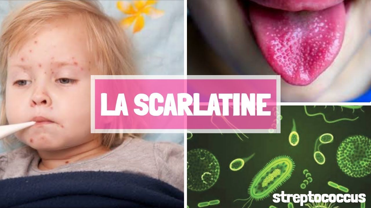 la scarlatine