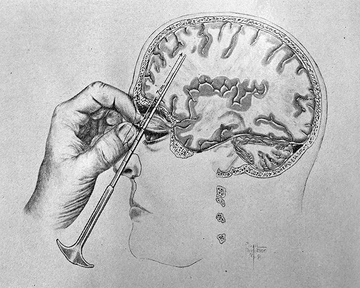 Die Lobotomie | Genially