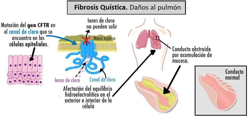 Anatomía De La Fibrosis Quística Fibrosis Quística Salud ABC