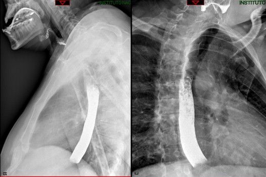 TRAGO DE BARIO O ESOFAGOGRAMA | Genially