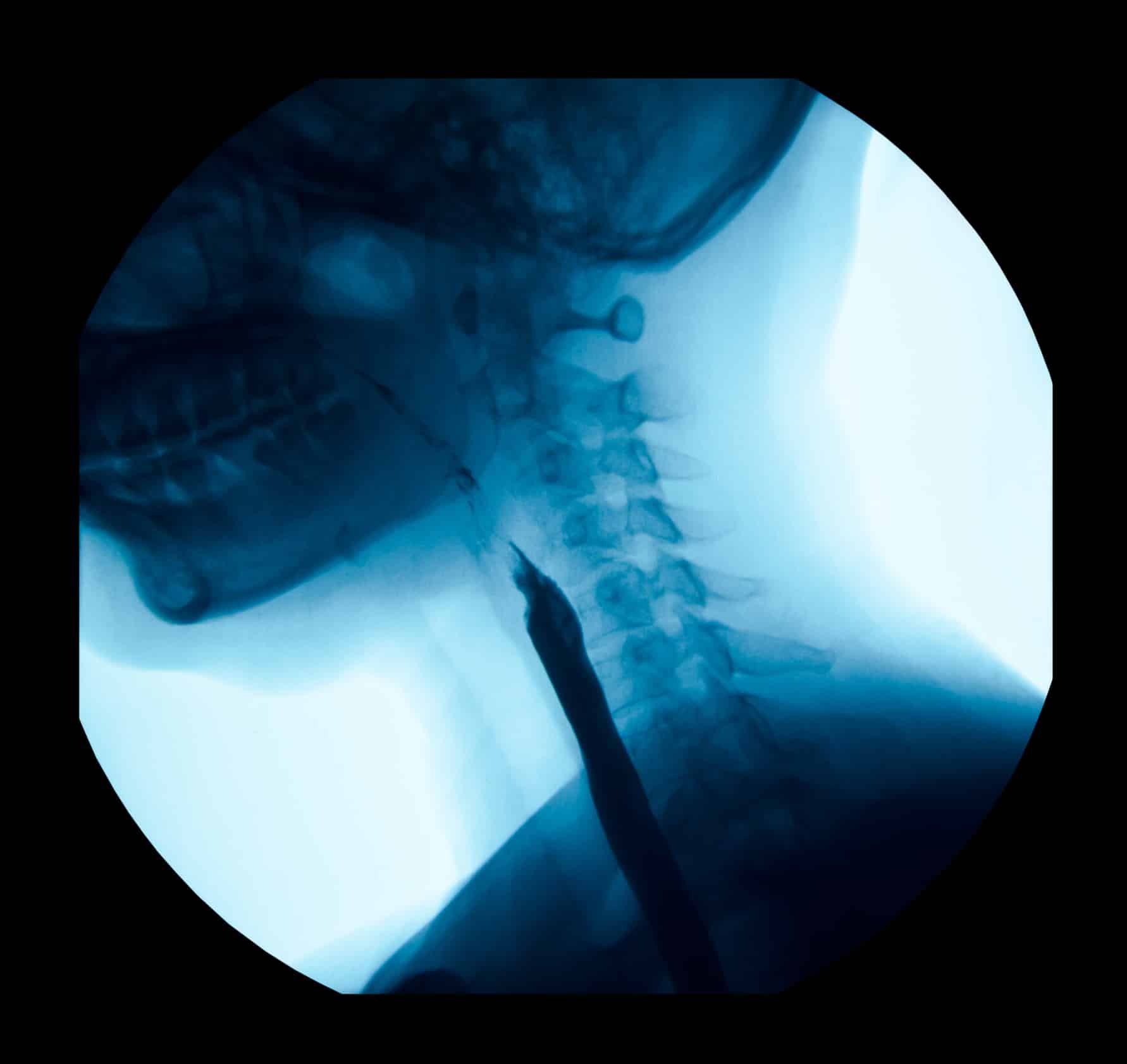 Anatomía Modificada Del Trago De Bario ESOFAGO BARITADO TRAGO DE