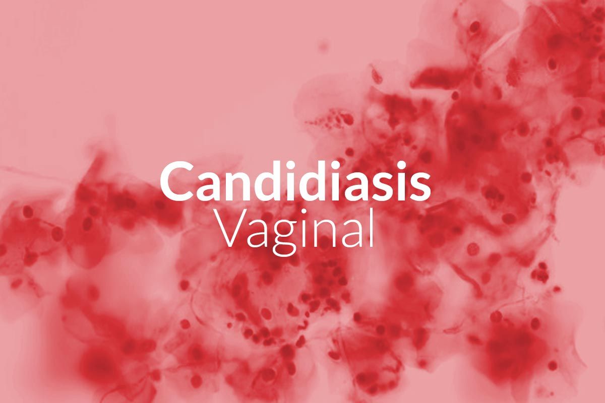 QUIZ SOBRE LA CANDIDIASIS VAGINAL | Genially