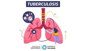 TUBERCULOSIS | Genially