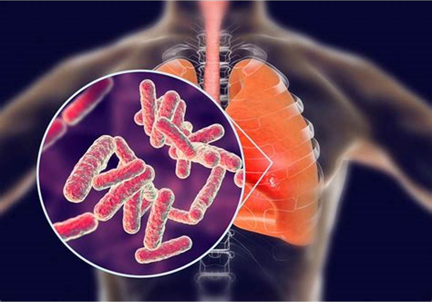 CADENA EPIDEMIOLÓGICA TUBERCULOSIS | Genially