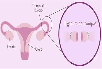 Infografía Métodos Anticonceptivos | Genially